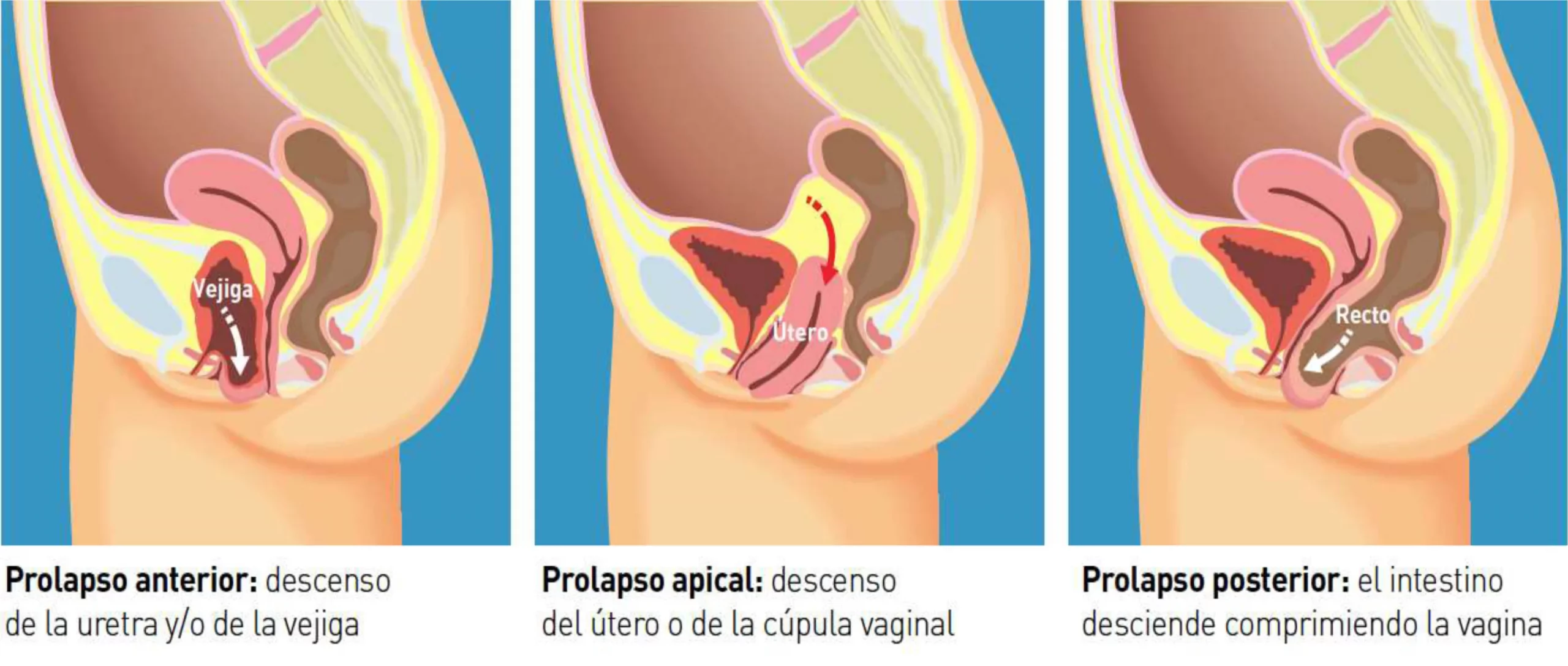 Prolapso Uterino En Mujeres Reparación De Los Prolapsos De Los